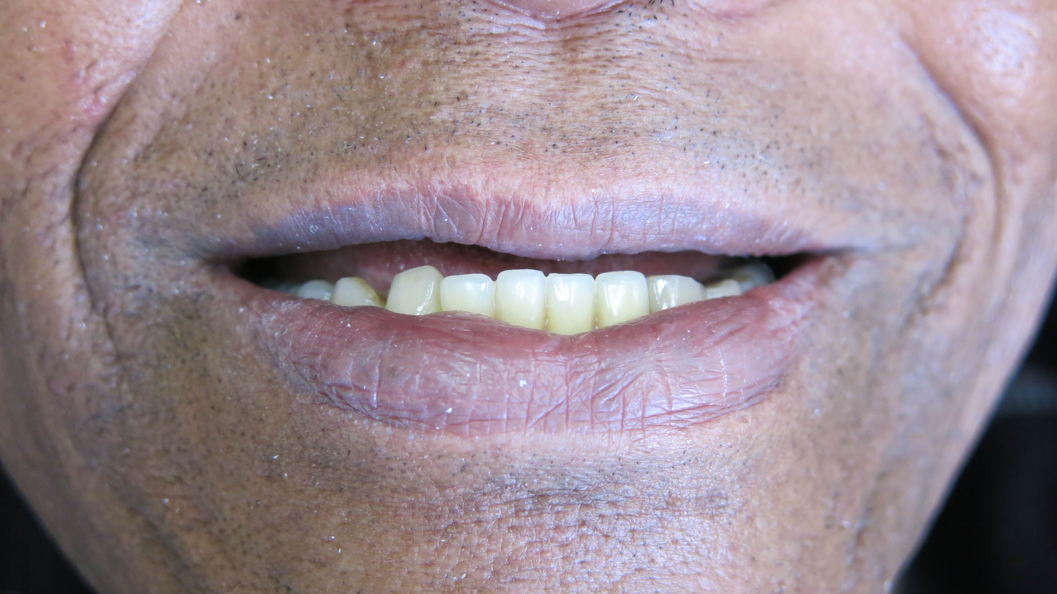 Los Angeles Dentist Before and After Photos | Tarzana Dental Care